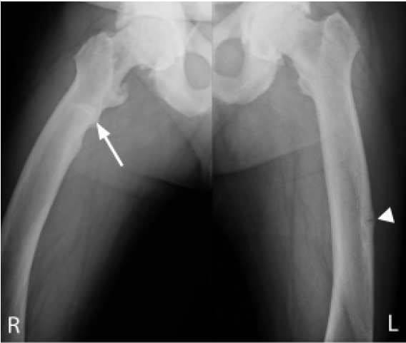 XLH Patient Case Studies | For HCPs