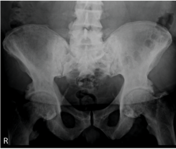 XLH Patient Case Studies | For HCPs