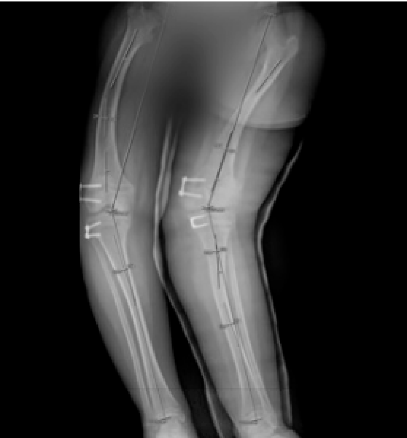 XLH Patient Case Studies | For HCPs