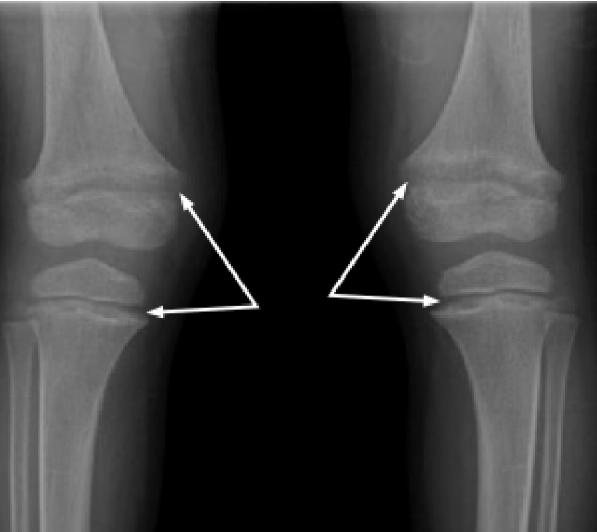 XLH Patient Case Studies | For HCPs