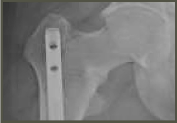 How to diagnose XLH | For HCPs