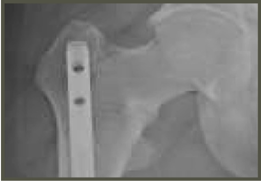 How to diagnose XLH | For HCPs